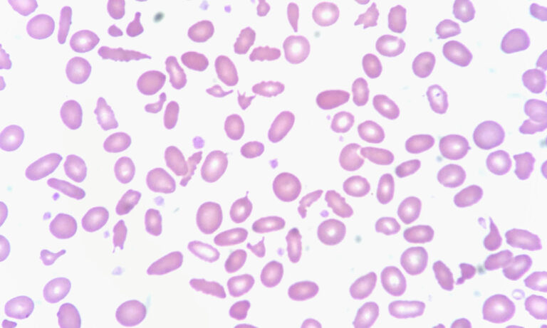 NOUL Blog | Understanding RBC Abnormalities: Diagnosing Anisocytosis ...