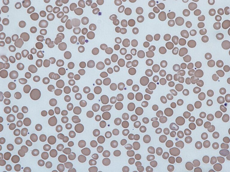 NOUL Blog | Understanding RBC Abnormalities: Diagnosing Anisocytosis ...