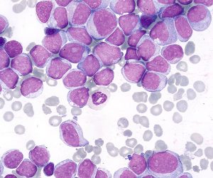 NOUL Blog | Understanding Leukemia Blood Smear & CBC Results Using ...