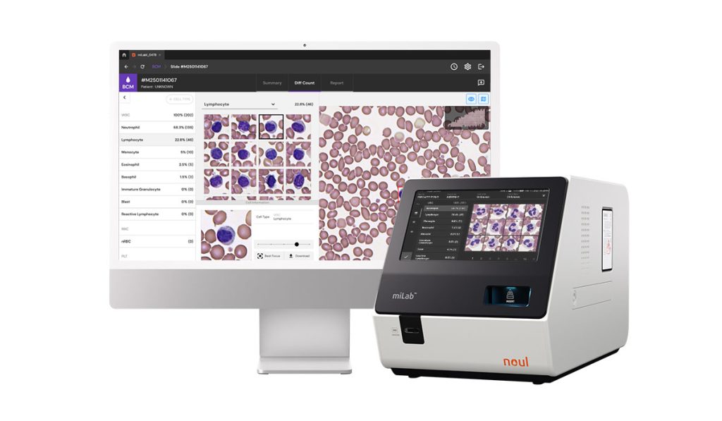 NOUL Blog | Abnormal WBC Morphology: Toxic Granulation ...