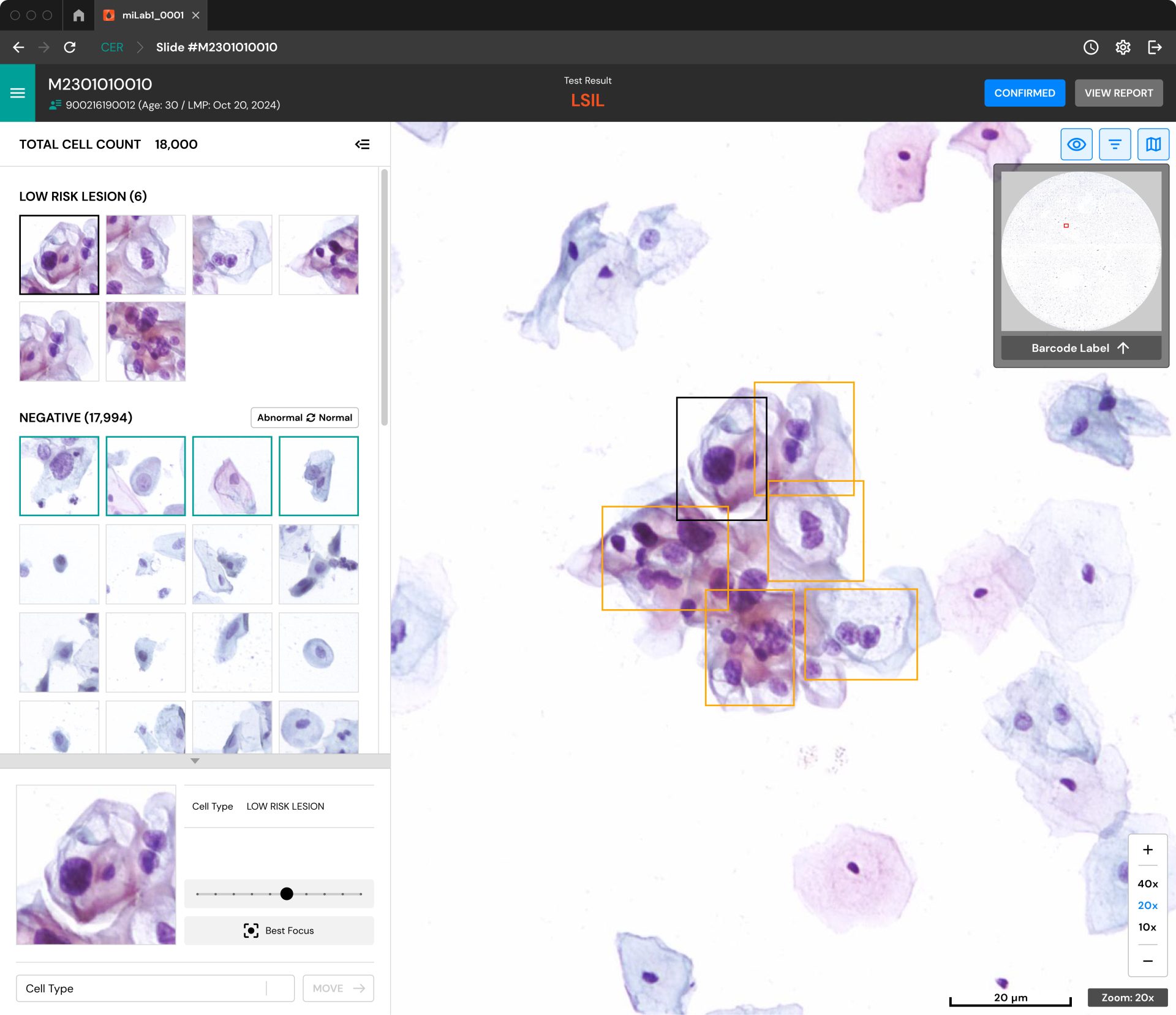 NOUL Blog | Friable Cervix, Glandular Cells, and Inflammation ...